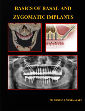 Basics of Basal and Zygomatic Implants - Anna’s Archive